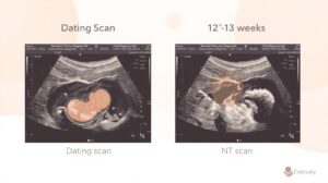 Your Pregnancy Dating Scan: What to Expect at Your First Ultrasound