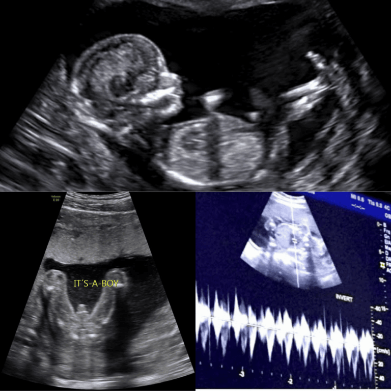 Anatomy Scan | Detailed 20-Week Ultrasound for Baby's Health