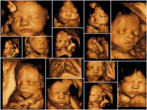 4D Scan - Watch Your Baby Move in Real-Time | Sonobee Ultrasound