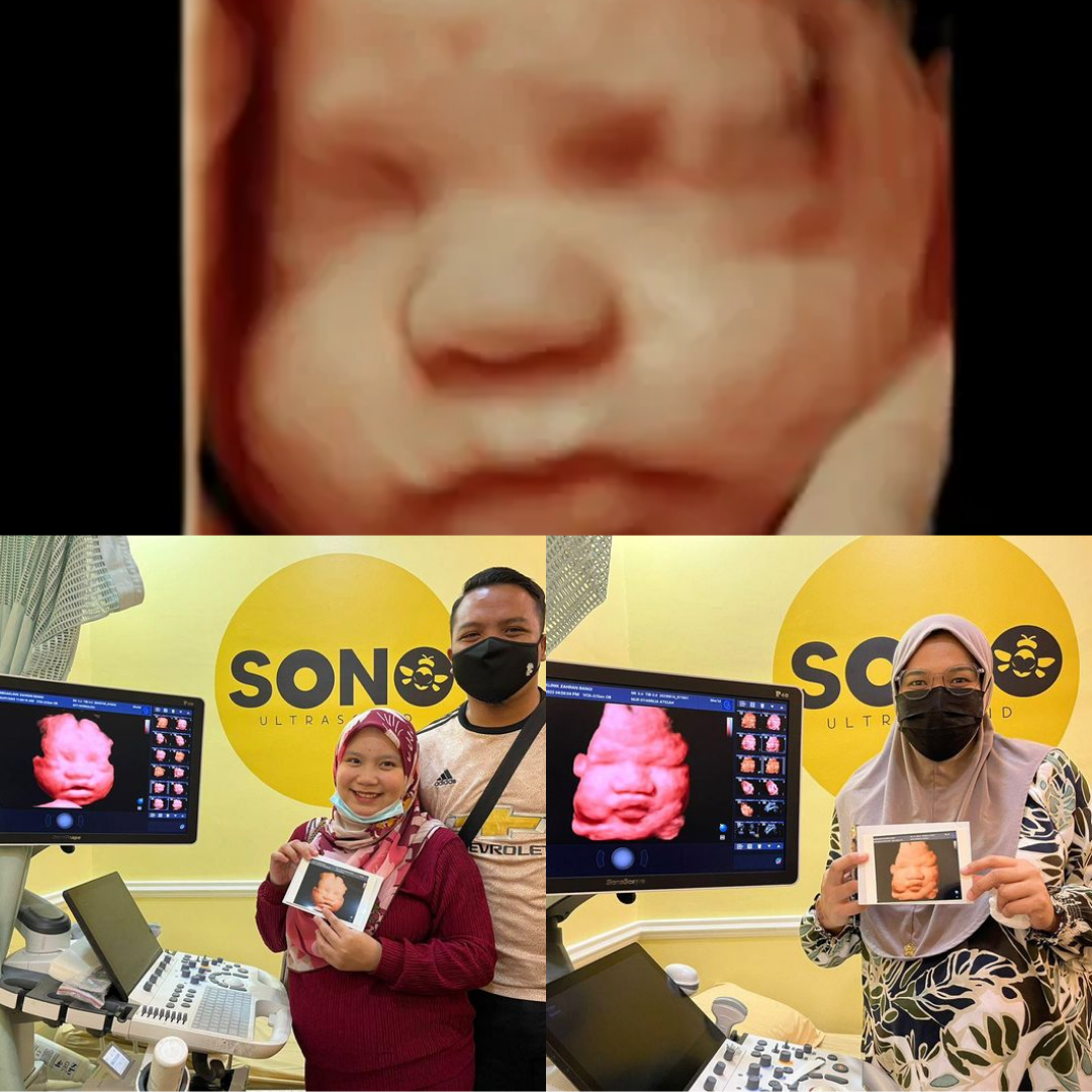 5D Scan - Meet Your Baby in Lifelike Detail | Sonobee Ultrasound