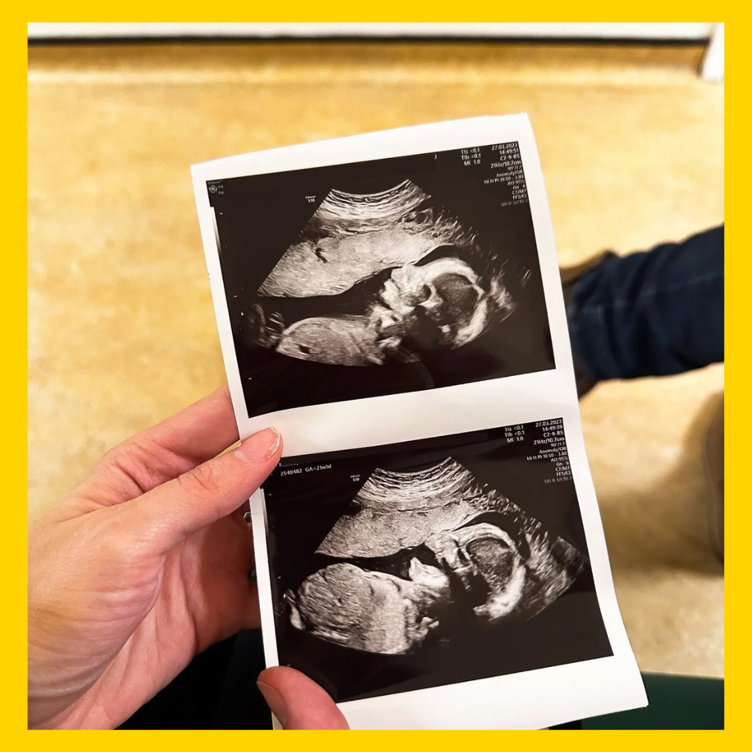 Anatomy Scan vs. Details Scan: Your Guide to Mid-Pregnancy Ultrasounds